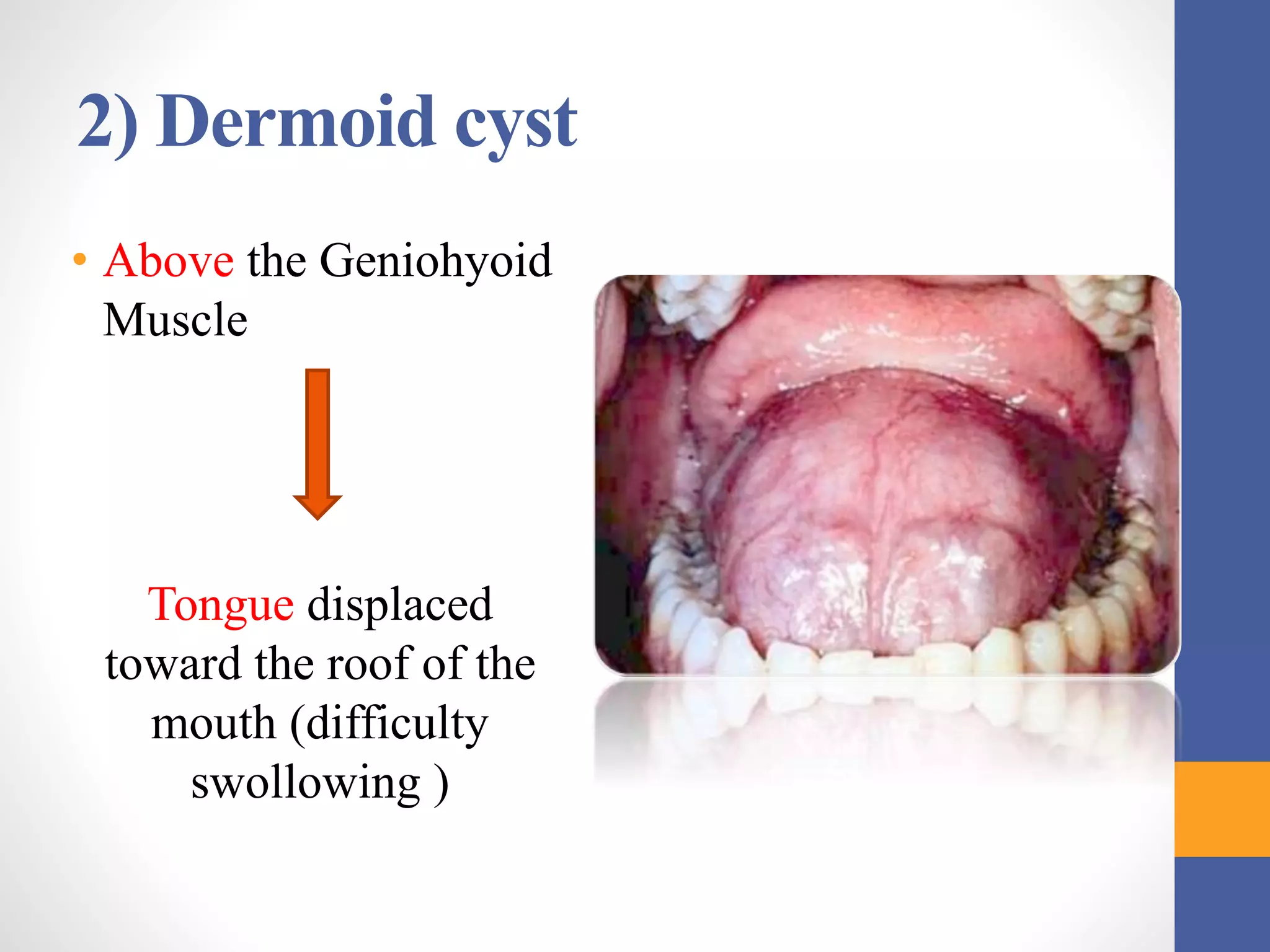 Cysts and tumors in pediatric dentistry | PPTX
