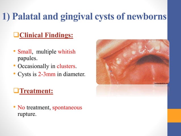 Cysts and tumors in pediatric dentistry | PPTX