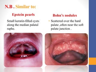 Cysts and tumors in pediatric dentistry | PPT