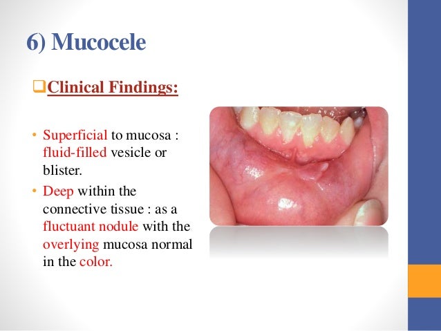 Mucocele Under Tongue
