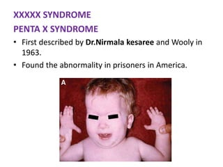 Penta X Syndrome