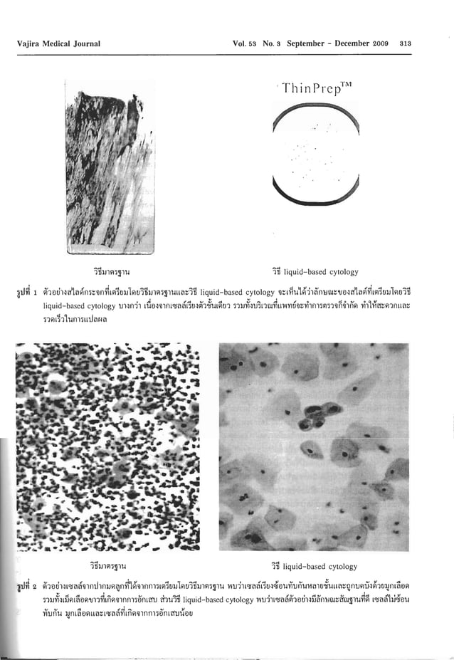 Liquid-based Cytology | PDF