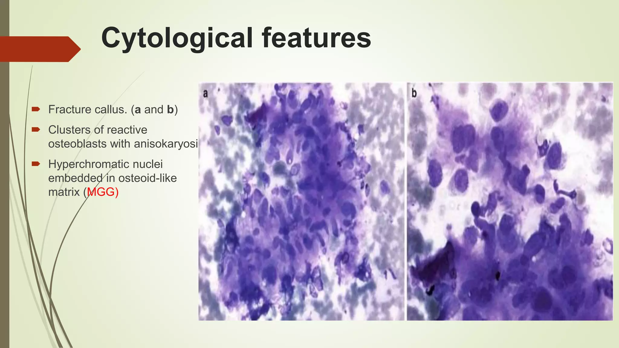 Cytology of bone lesions | PPTX