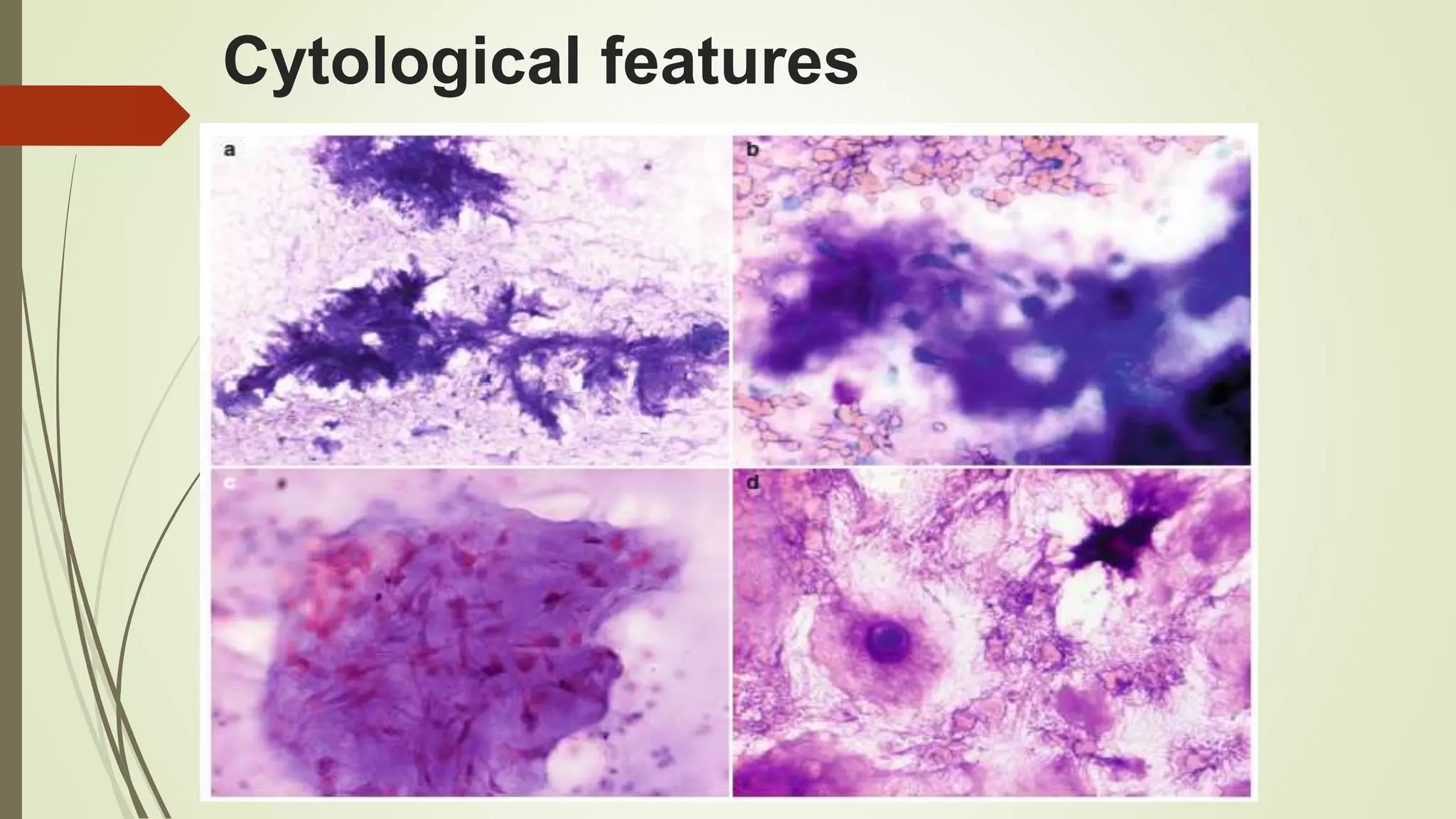 Cytology of bone lesions | PPTX
