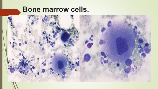 Cytology of bone lesions | PPTX