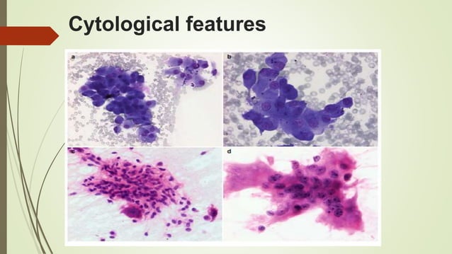 Cytology of bone lesions | PPTX