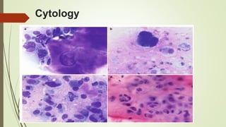 Cytology of bone lesions | PPTX