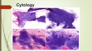 Cytology of bone lesions | PPTX