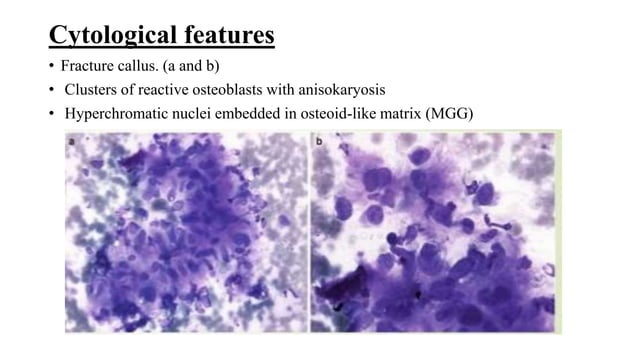 CYTOLOGY OF BONE LESIONS.pptx