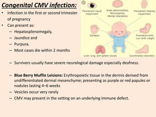 Cytomegalovirus Made Very Easy! | PPTX