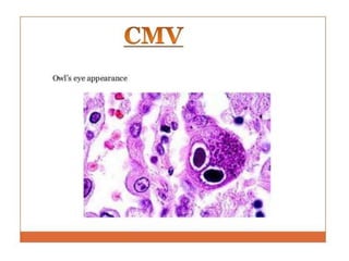 CYTOMEGALOVIRUS.pptx for educational purposes | PPTX | Infectious ...