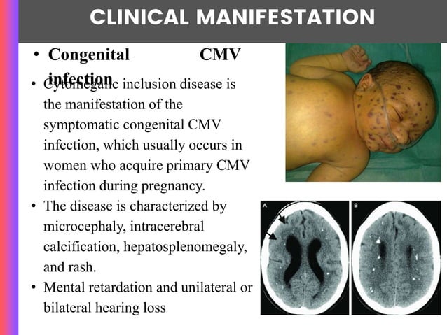 Microbiology of Cytomegalovirus (Herpes).pptx