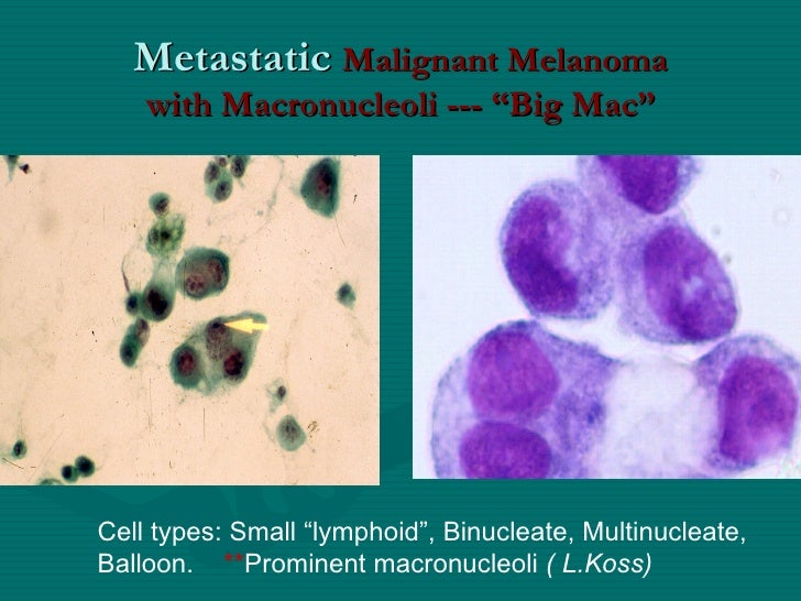 Malignant Cells In Csf