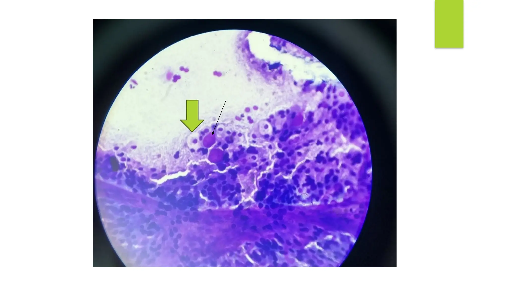 Cytology Slide Disscussion presentation for pathology | PPTX
