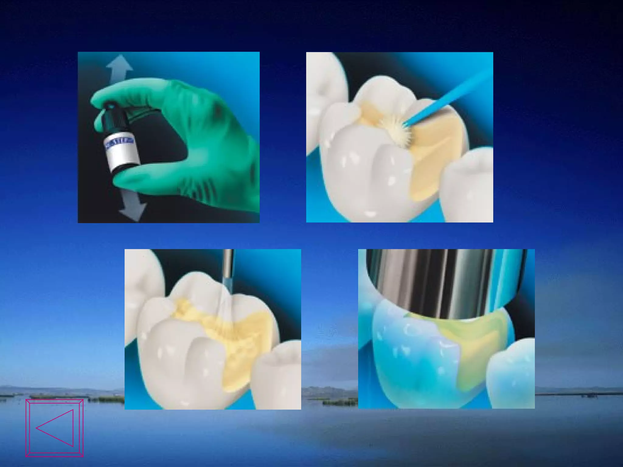 Operative Dentistry 3 | PPT