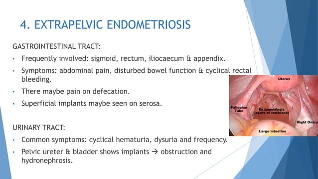 Endometriosis | PPTX | Pregnancy | Reproductive Health
