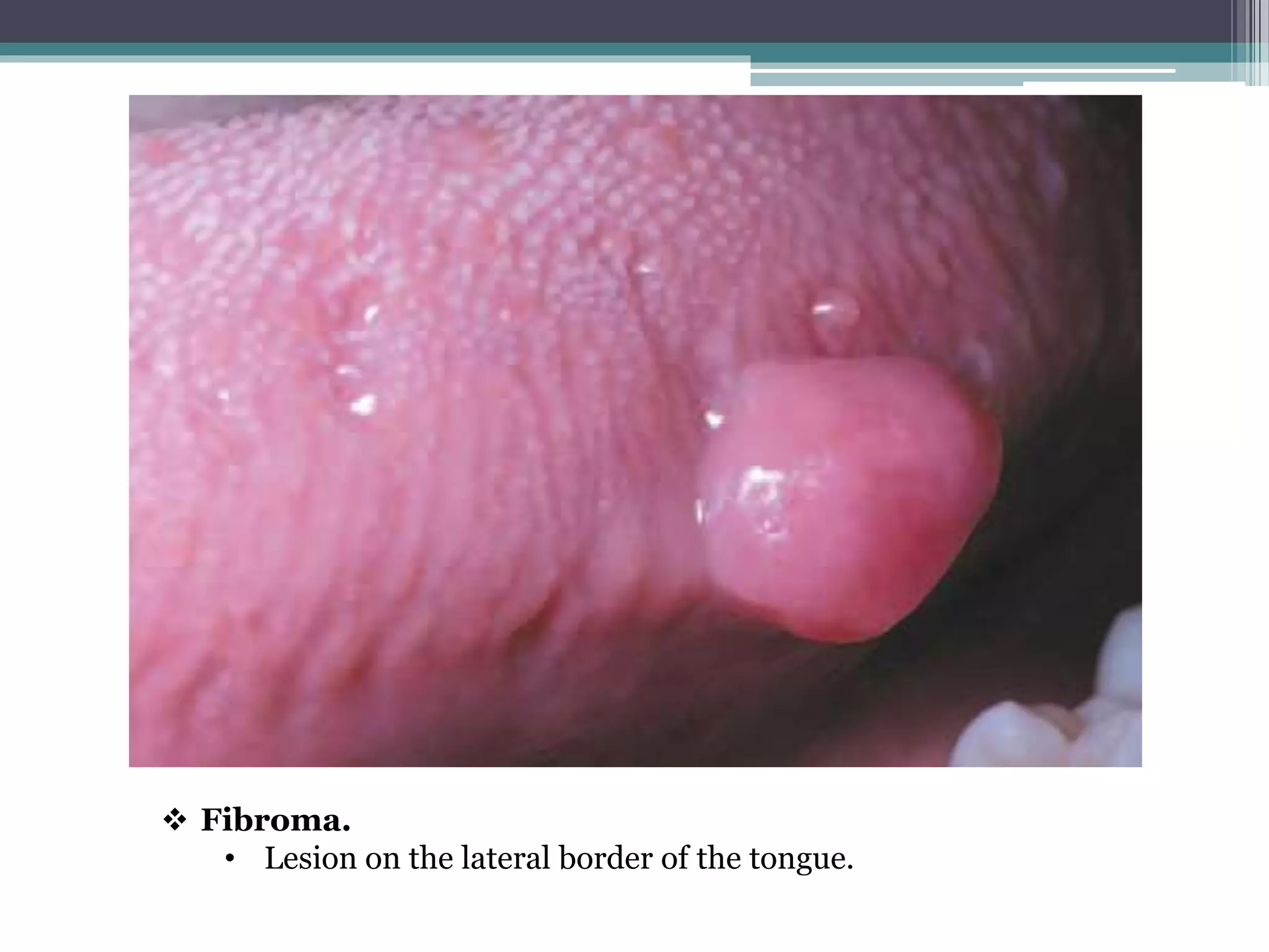 D.D of tongue swelling | PPTX