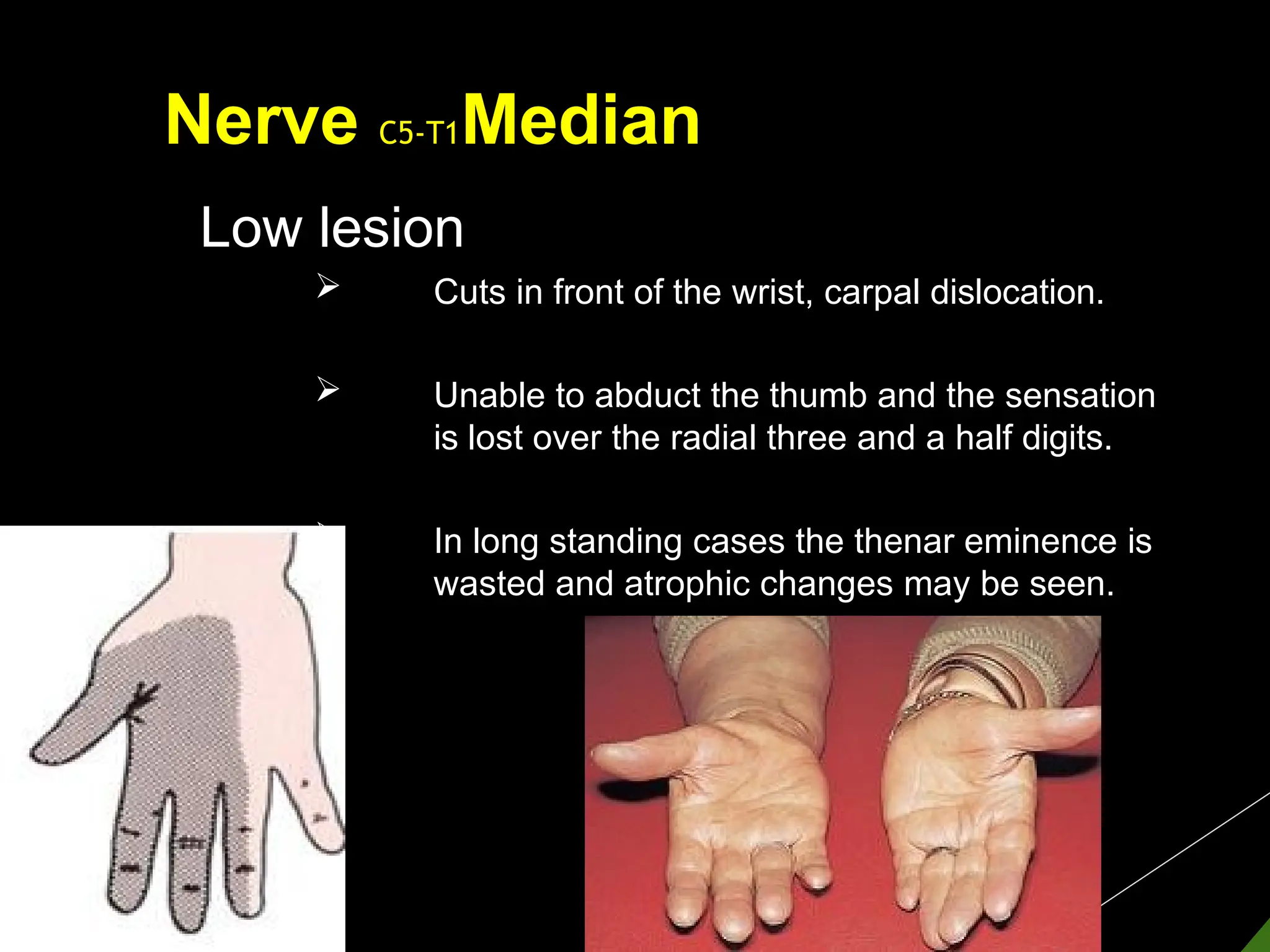 D. Jamal Peripheral nerve injuries-1 (Muhadharaty).pptx