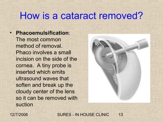 cataract-information | PPS