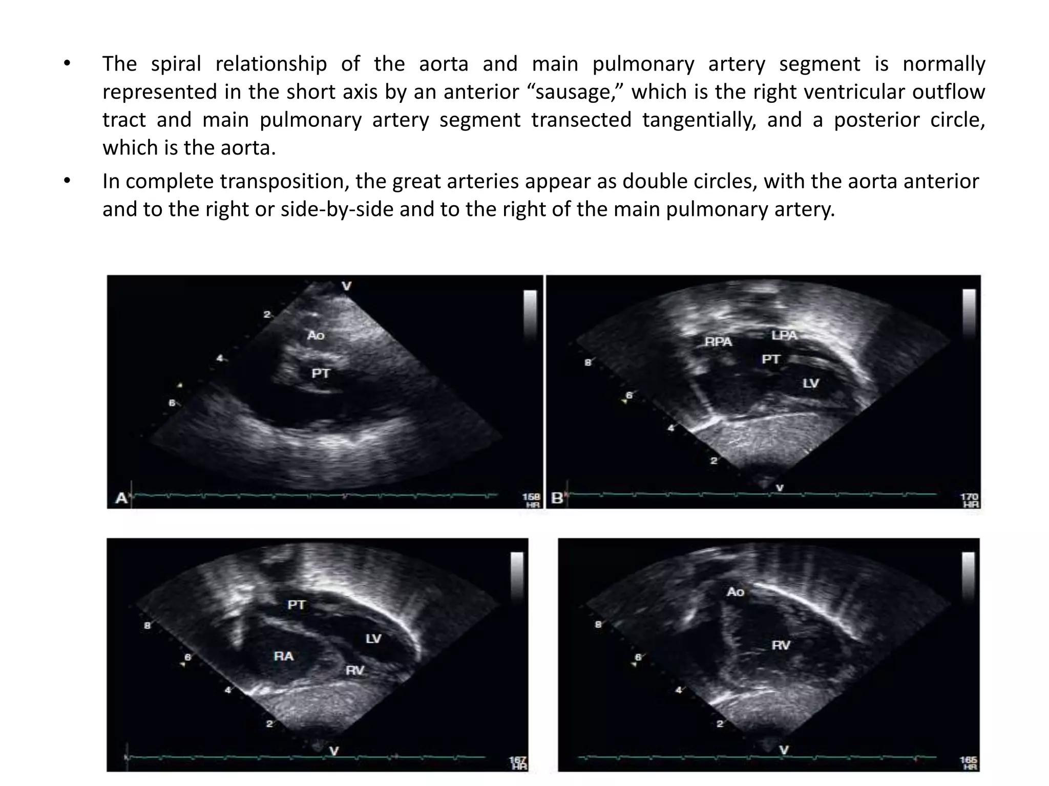 D tga, echo & hemodynamic features of | PPTX