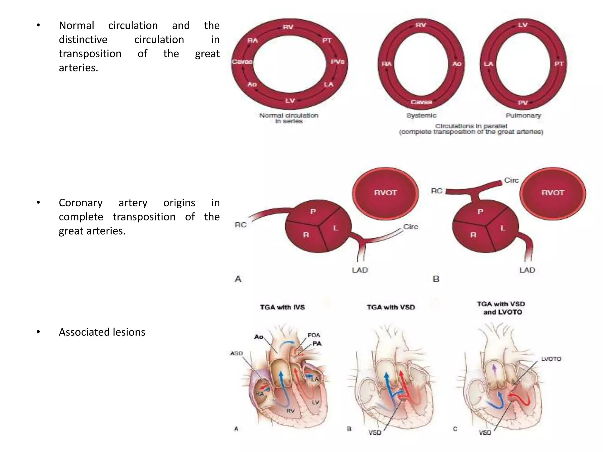 D tga, echo & hemodynamic features of | PPTX