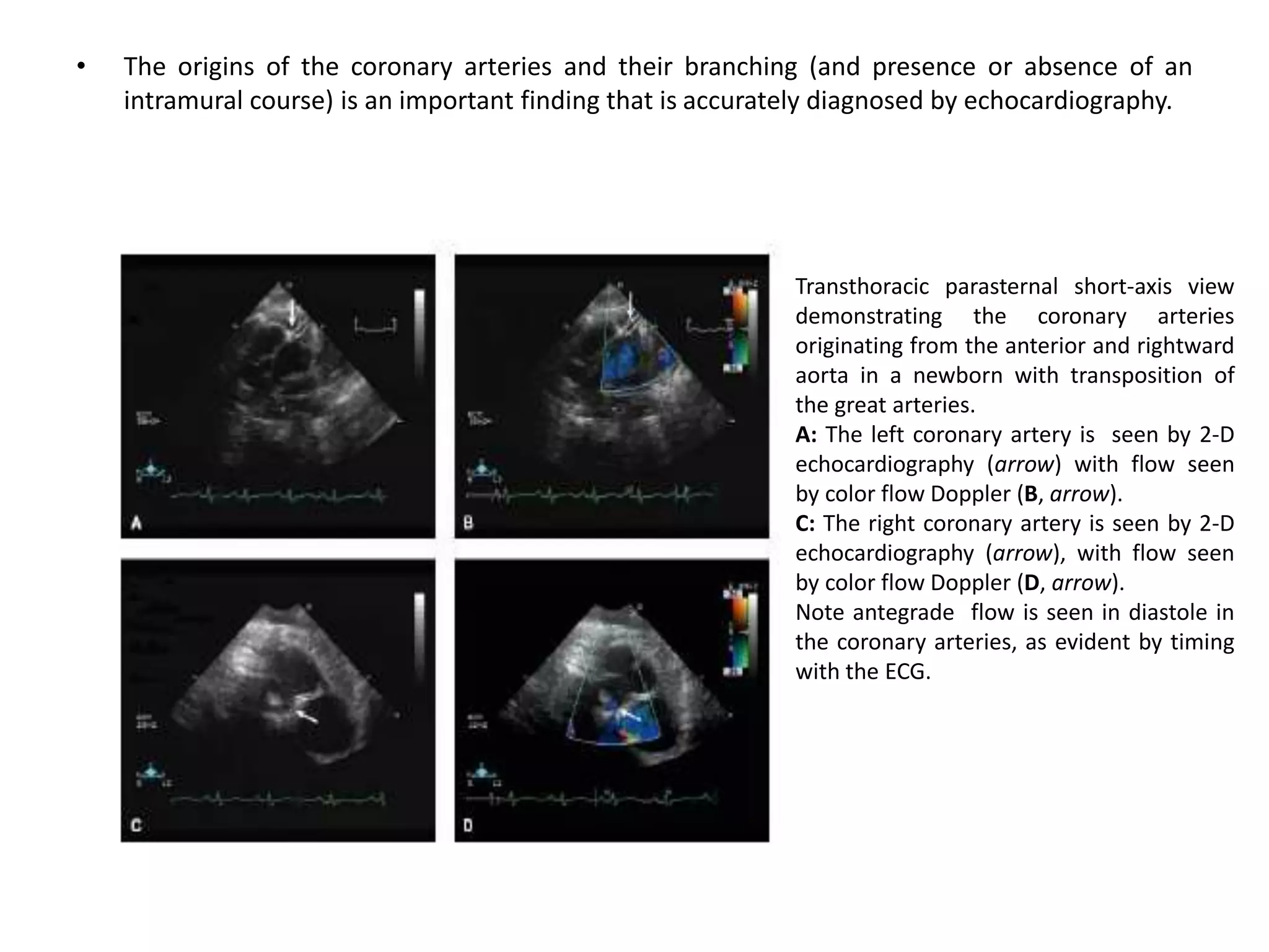 D tga, echo & hemodynamic features of | PPTX