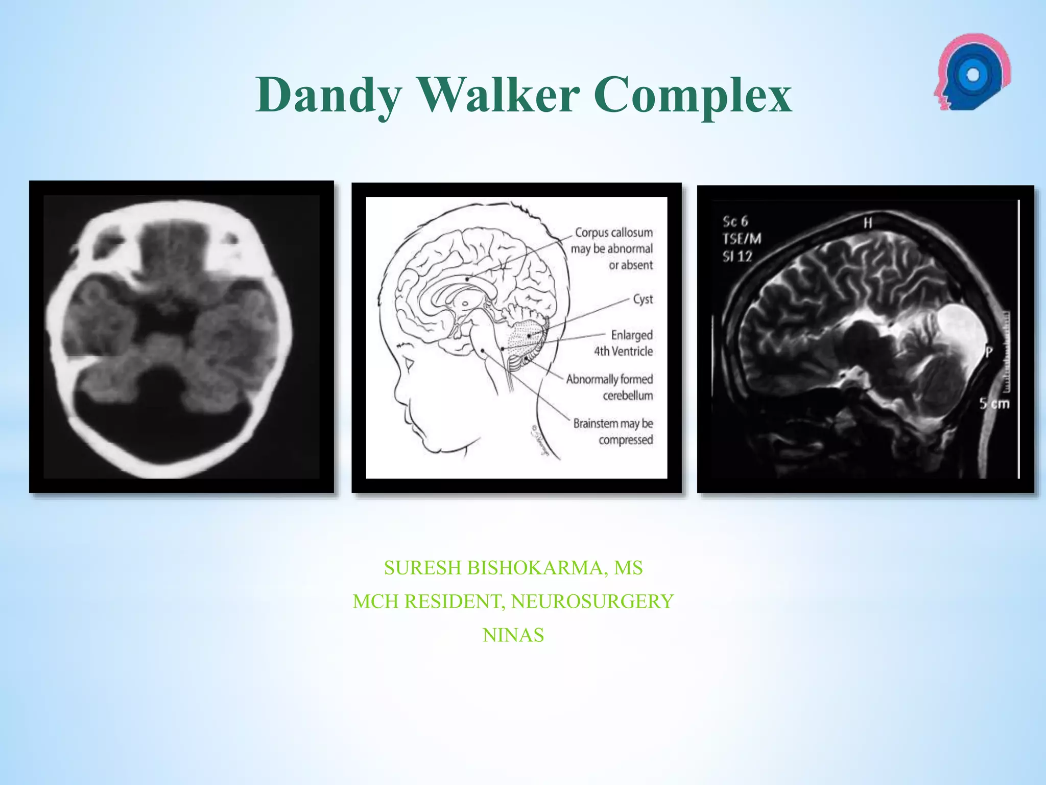 Dandy Walker syndrome | PPTX | Pregnancy | Reproductive Health