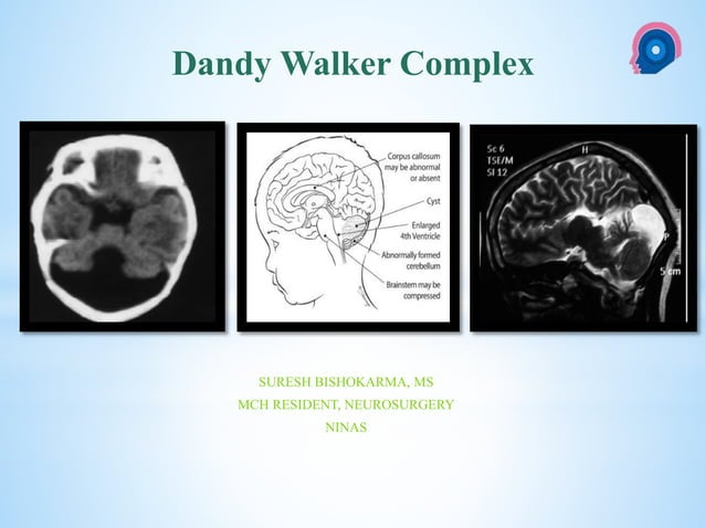 Dandy Walker syndrome | PPTX | Pregnancy | Reproductive Health