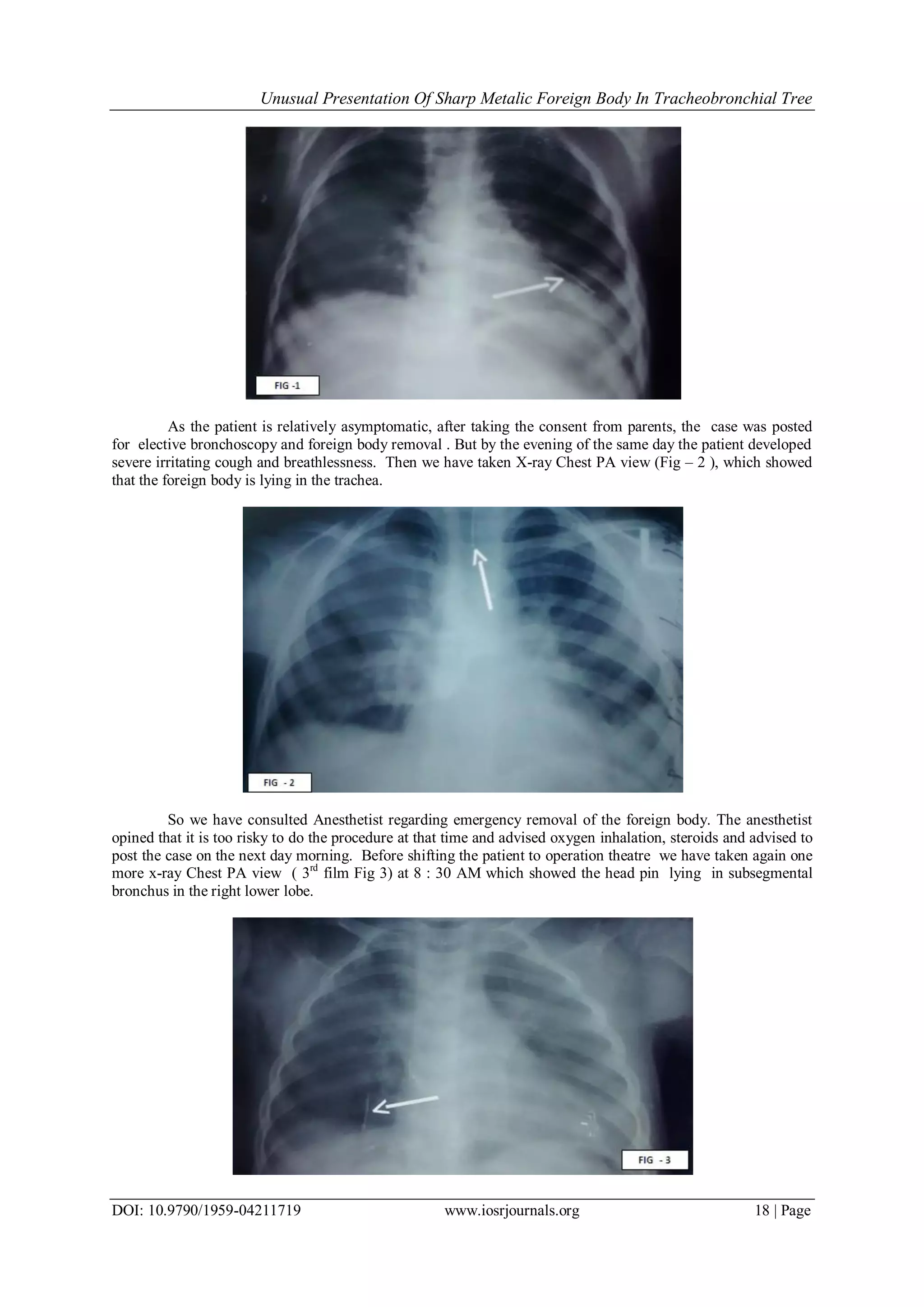 Unusual Presentation of Sharp Metalic Foreign Body in Tracheobronchial ...