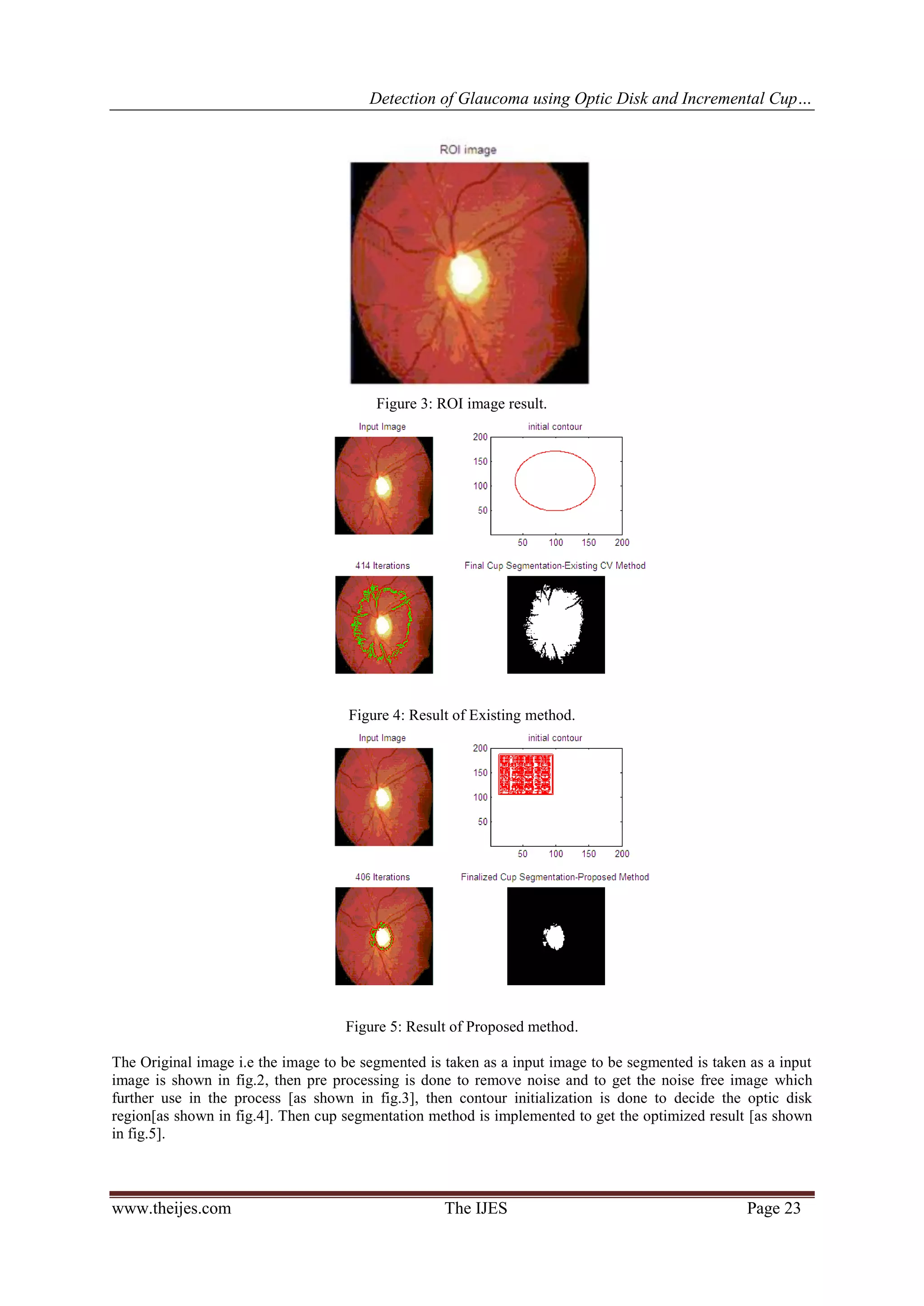 Detection Of Glaucoma Using Optic Disk And Incremental Cup Segmentation From Retinal Image Pdf