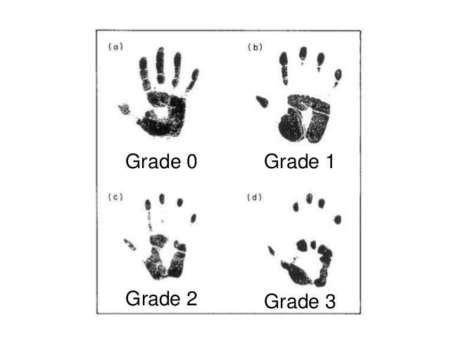 Diabetic Stiff Joint Syndrome