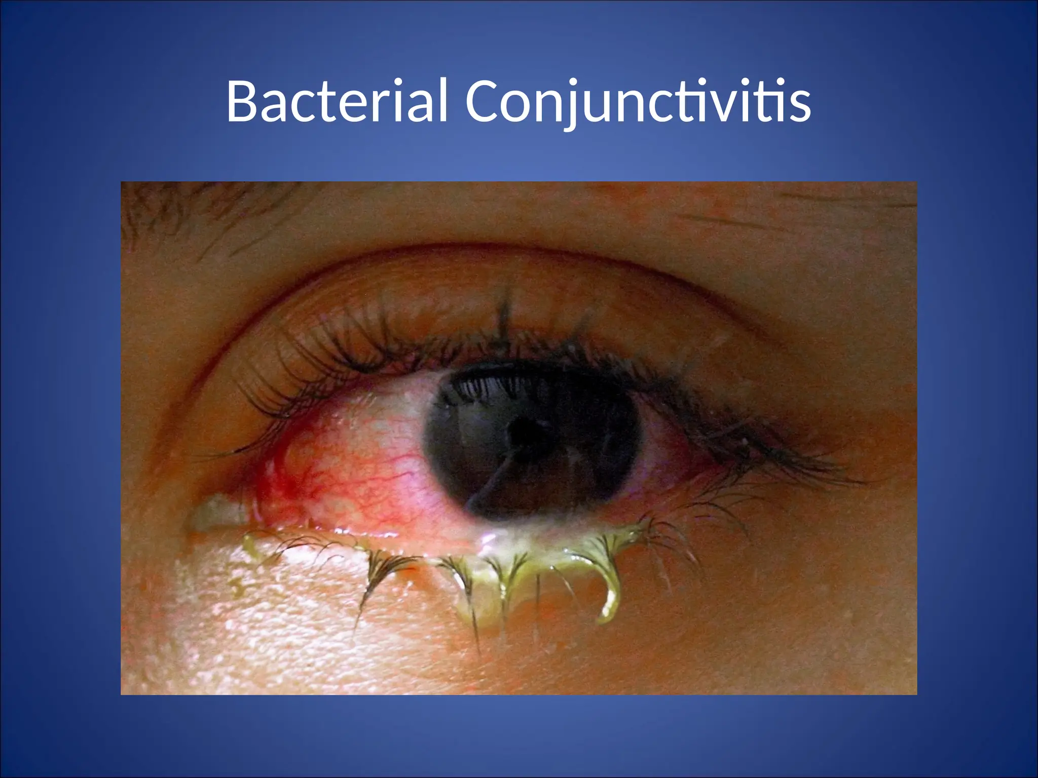 D1 - Applied Anatomy of Conjunctiva & Classification of Conjunctivitis.ppt