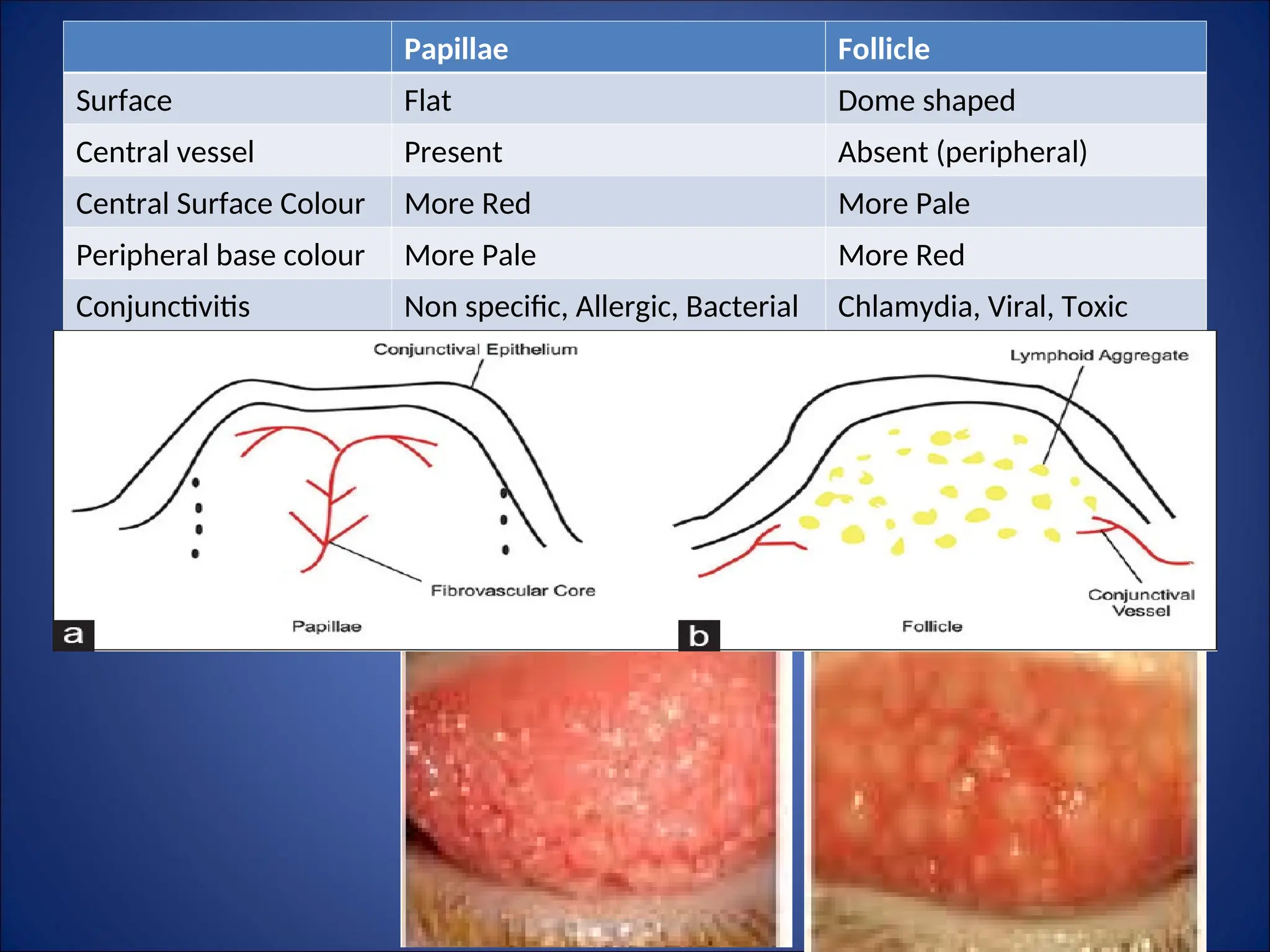 D1 - Applied Anatomy of Conjunctiva & Classification of Conjunctivitis.ppt