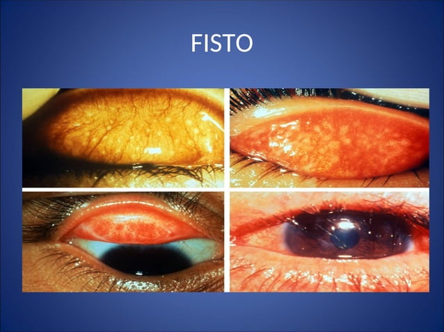 D1 - Applied Anatomy of Conjunctiva & Classification of Conjunctivitis.ppt