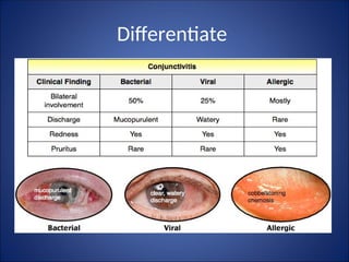 D1 - Applied Anatomy of Conjunctiva & Classification of Conjunctivitis.ppt
