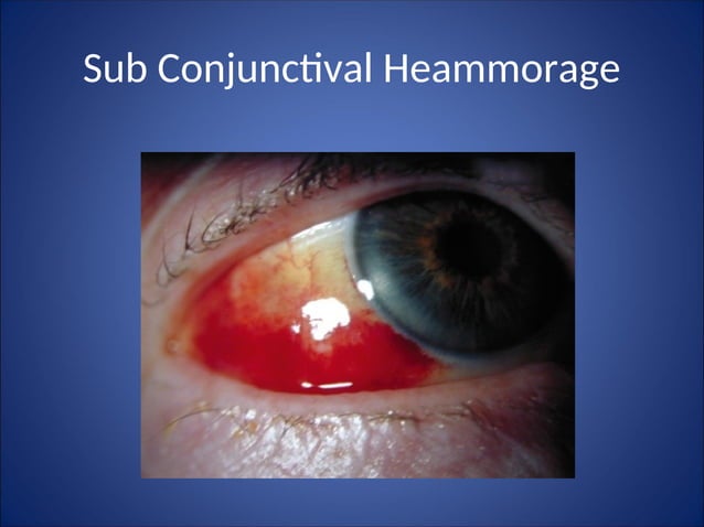D1 - Applied Anatomy of Conjunctiva & Classification of Conjunctivitis.ppt
