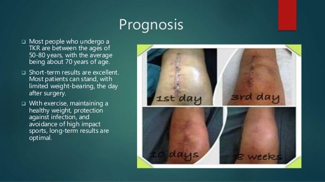 Total Knee Replacement (1)