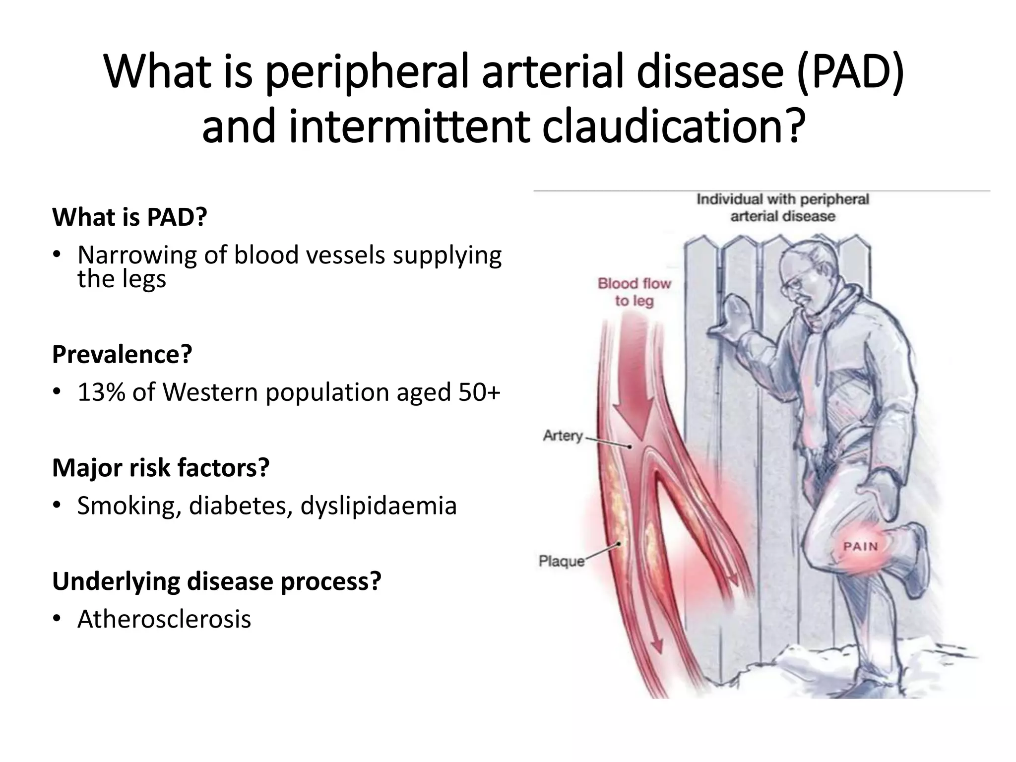 Exercise and intermittent claudication | PPTX