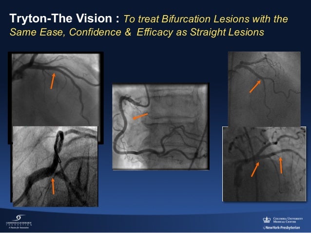 P. Genereux, the tryton stent_dedicated bifurcation stent in coronary…
