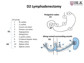 D2 gastrectomy | PPT