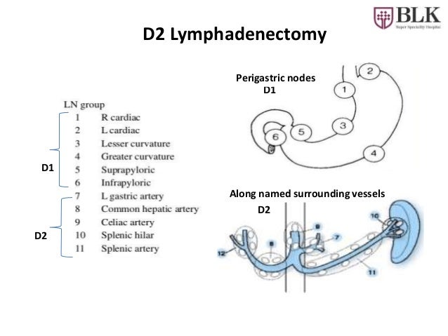 D2 Gastrectomy