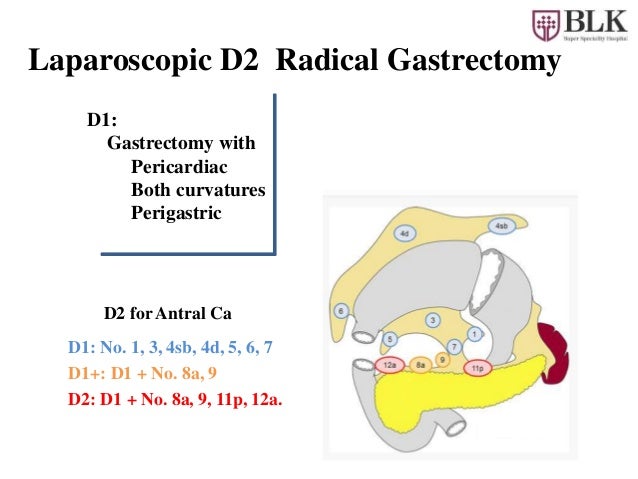 D2 gastrectomy