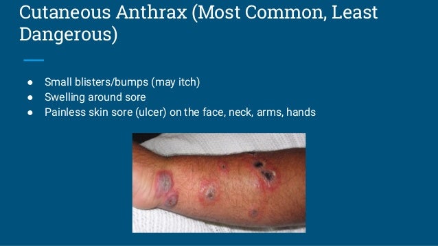 Anthrax