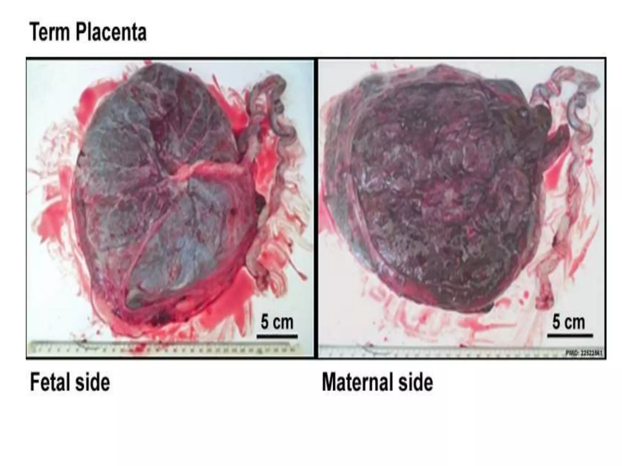 placental dissection | PPT