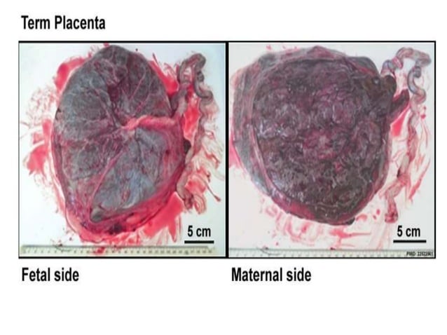 placental dissection | PPTX | Pregnancy | Reproductive Health