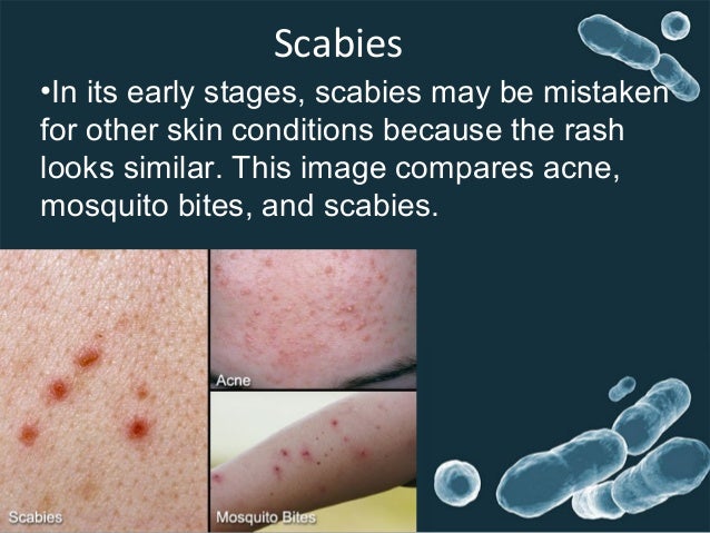 Early Scabies Rash