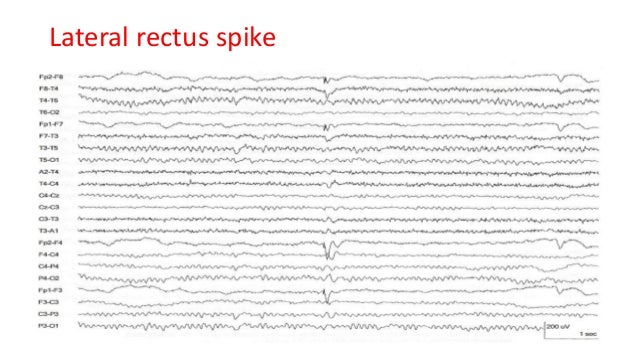 EMG artifact presentation