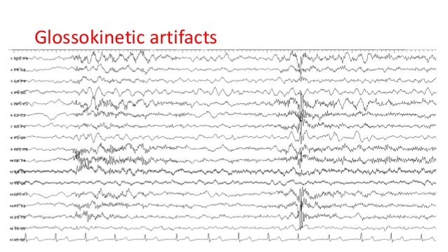 EMG artifact presentation