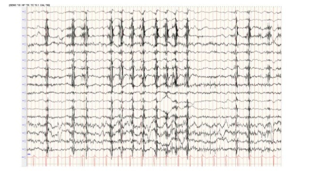 EMG artifact presentation