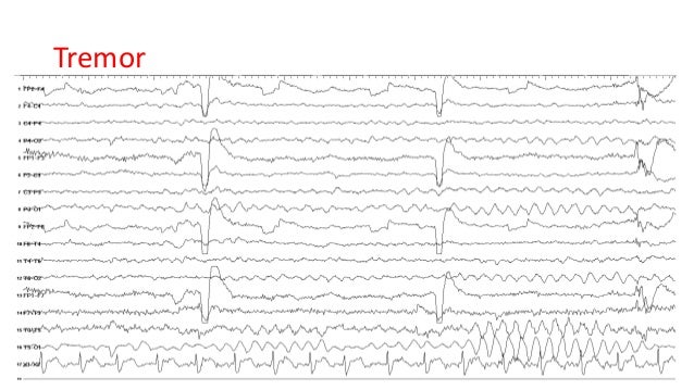 EMG artifact presentation